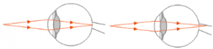 Nearsightedness eye - Physics